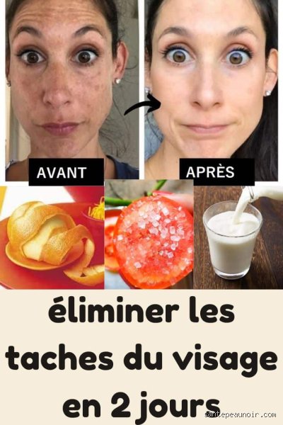 Comment enlever définitivement les tâches sur le visage : La réalité ...