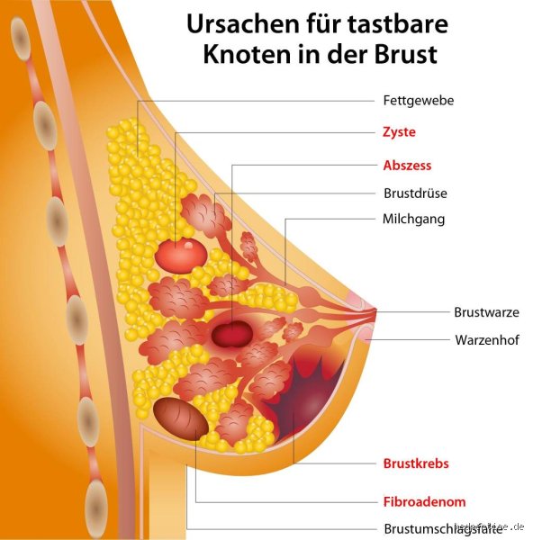 Knoten In Der Brust Schmerzt