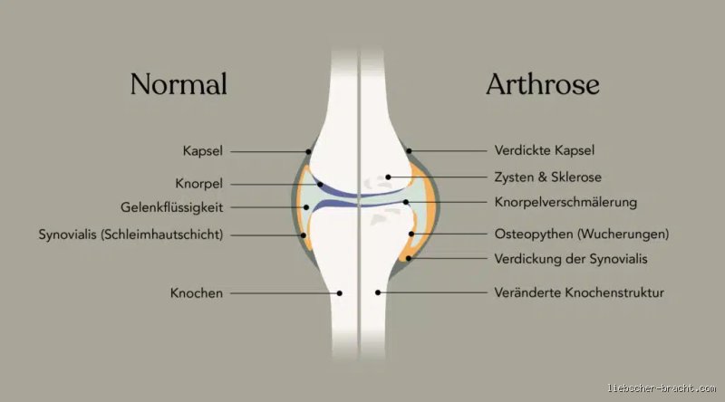 Wie erkenne ich Arthrose?