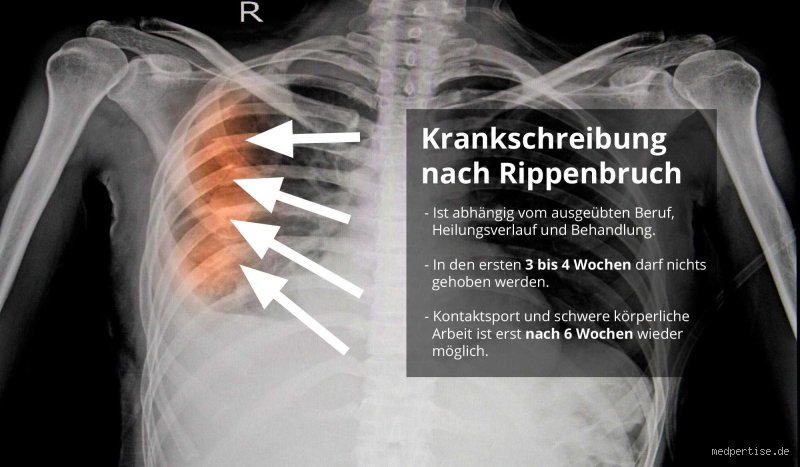 Wie erkenne ich eine geprellte Rippe?