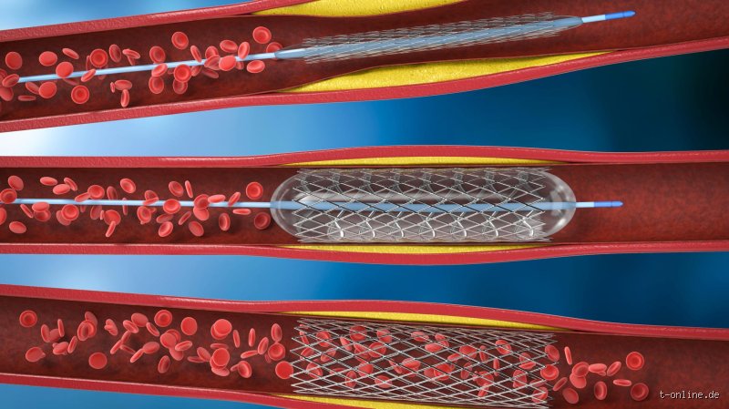 Wie lange Blutverdünner bei Stent?