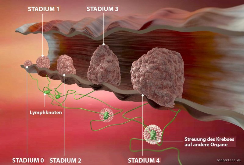 Wie lange dauert es bis Darmkrebs Metastasen bildet?