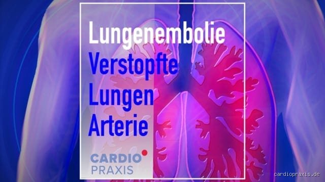 Wie lange dauert es bis zur Lungenembolie?