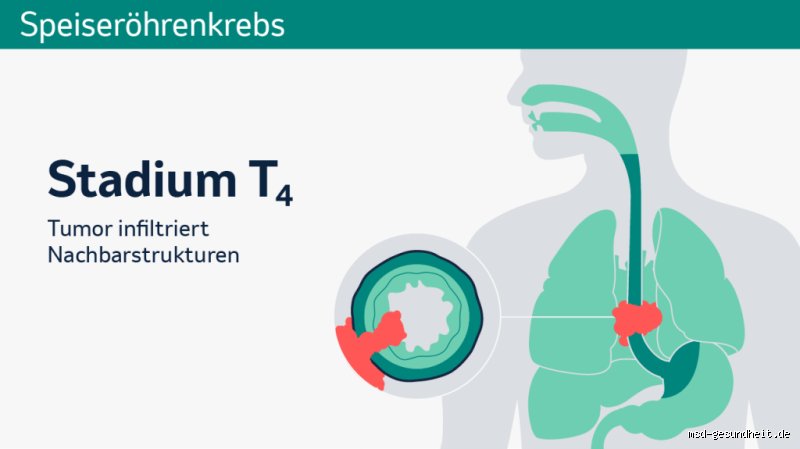 Wie merkt man einen Tumor in der Speiseröhre?