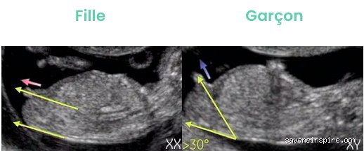 Comment reconnaître un garçon ou une fille sur une échographie
