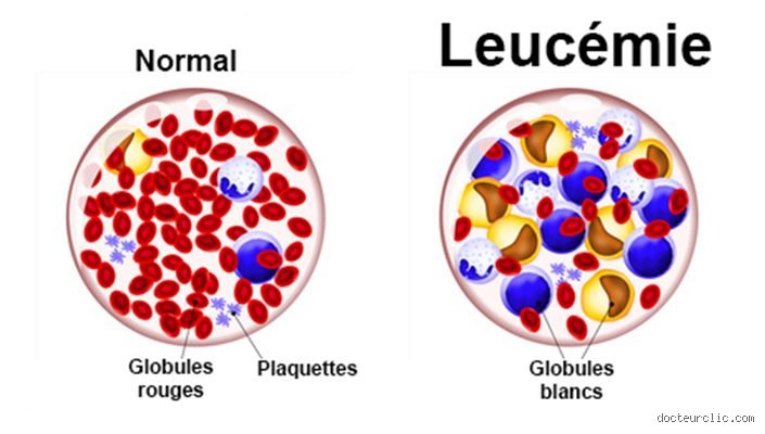 Qu'est-ce qu'une préleucémie