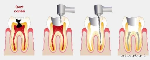 Dent dévitalisée : quand l'arracher devient une nécessité (et pourquoi ...