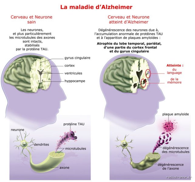 Quelles parties du cerveau sont touchées par la maladie d'Alzheimer