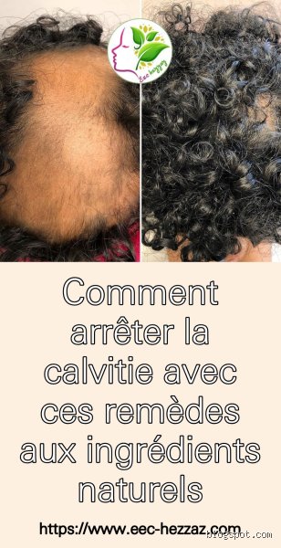 Comment ne pas avoir de calvitie plus tard