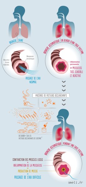 Comment faire passer une bronchite asthmatique ? Guide expert pour ...