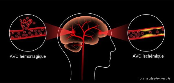 Le lien insidieux : Comment le stress peut provoquer un AVC et pourquoi ...