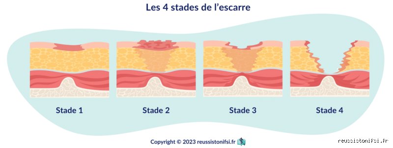 Comment savoir si il faut recoudre une plaie