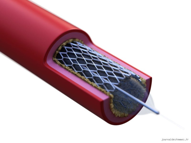 Une artère munie d'un stent peut-elle se boucher à nouveau ? Vérités ...