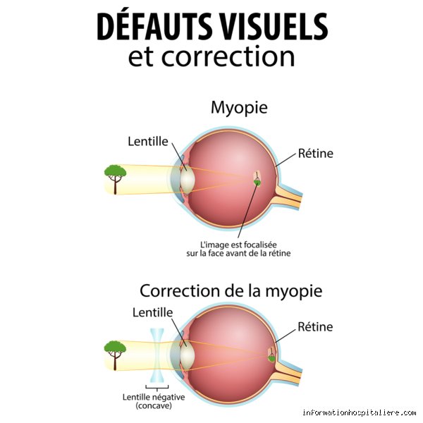 Comment ne pas être myope